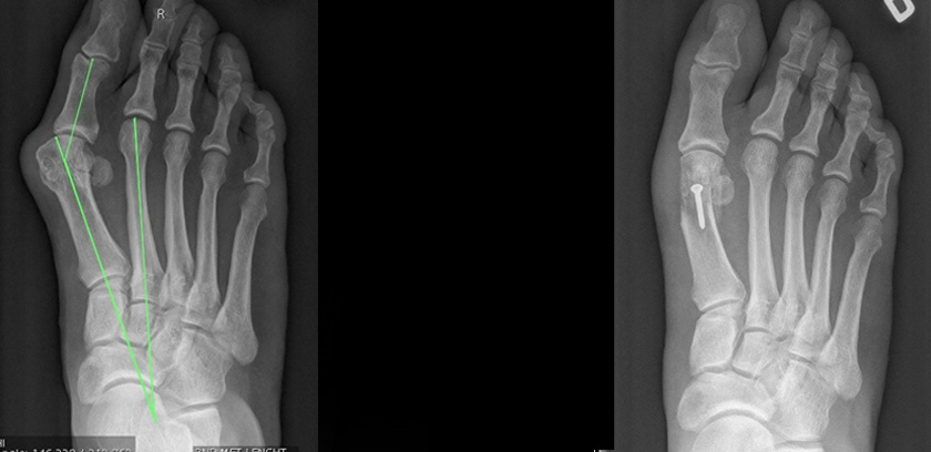 Hallux valgus or bunions | Dr. Hobeychi, podiatrist