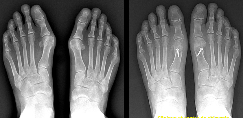 Hallux valgus or bunions | Dr. Hobeychi, podiatrist